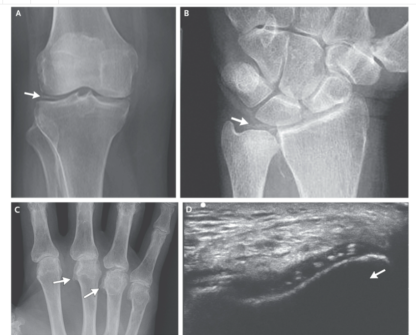ピロリン酸カルシウム沈着症(CPPD)│不識庵-万年研修医のブログ-